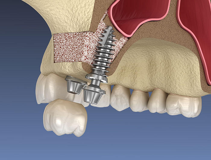 Sinus Lifting and Bone Augmentations | Sirinyali Dental Clinic Antalya ...